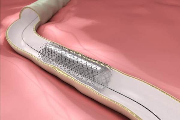 From high blood pressure to life-saving stent